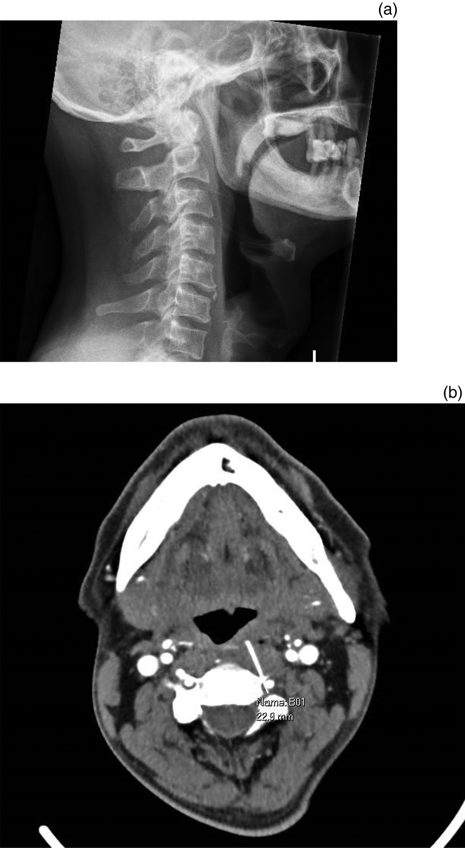 Transoral endoscopic approach to upper cervical spine migrated foreign ...