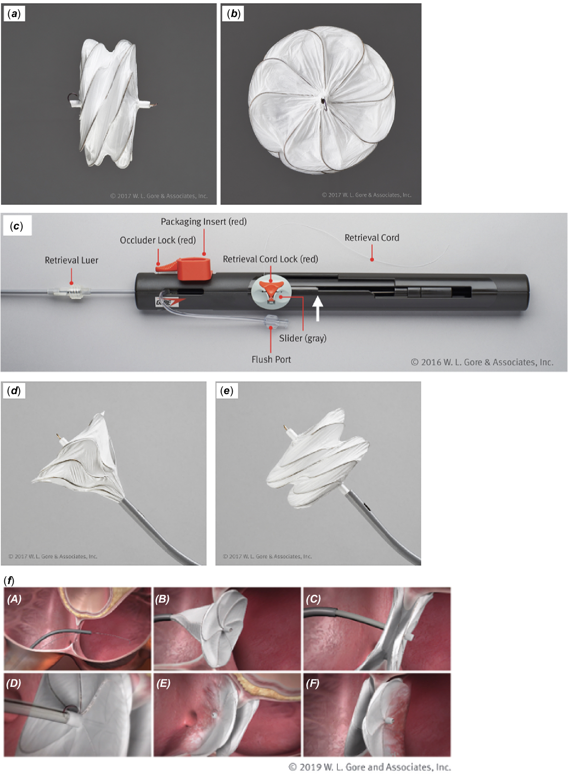 Gore Cardioform atrial septal occluder: deployment procedure and ...