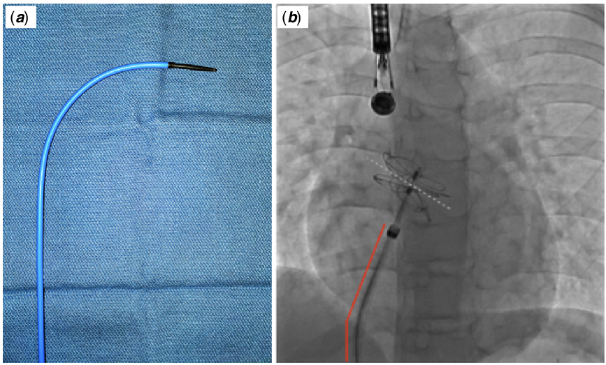 Gore Cardioform atrial septal occluder: deployment procedure and ...