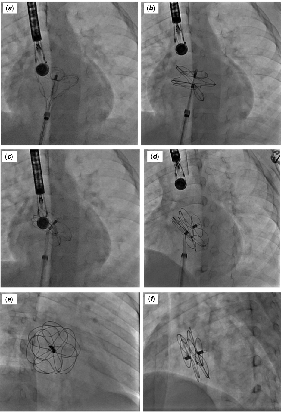 Gore Cardioform atrial septal occluder: deployment procedure and ...