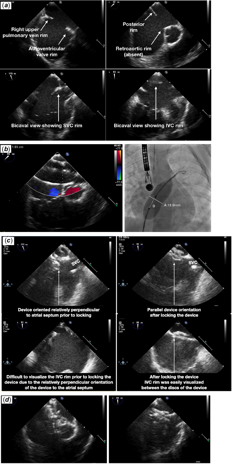 Gore Cardioform atrial septal occluder: deployment procedure and ...