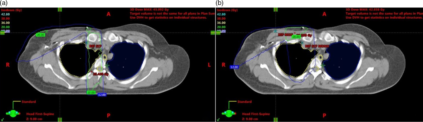 Mono versus dual isocentric technique for breast cancer radiotherapy ...