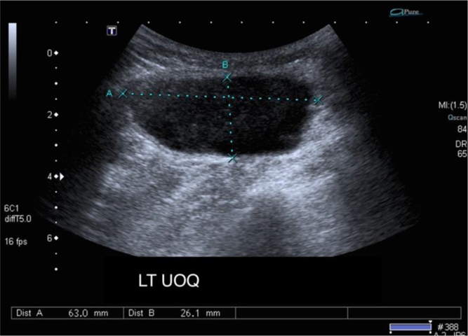 Post IORT seroma complication in breast cancer surgery | Journal of ...