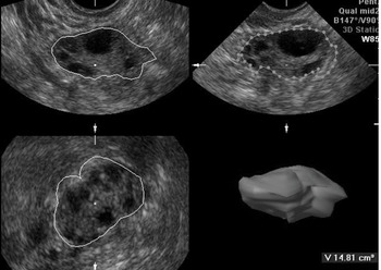 Monitoring Ovulation Ultrasound