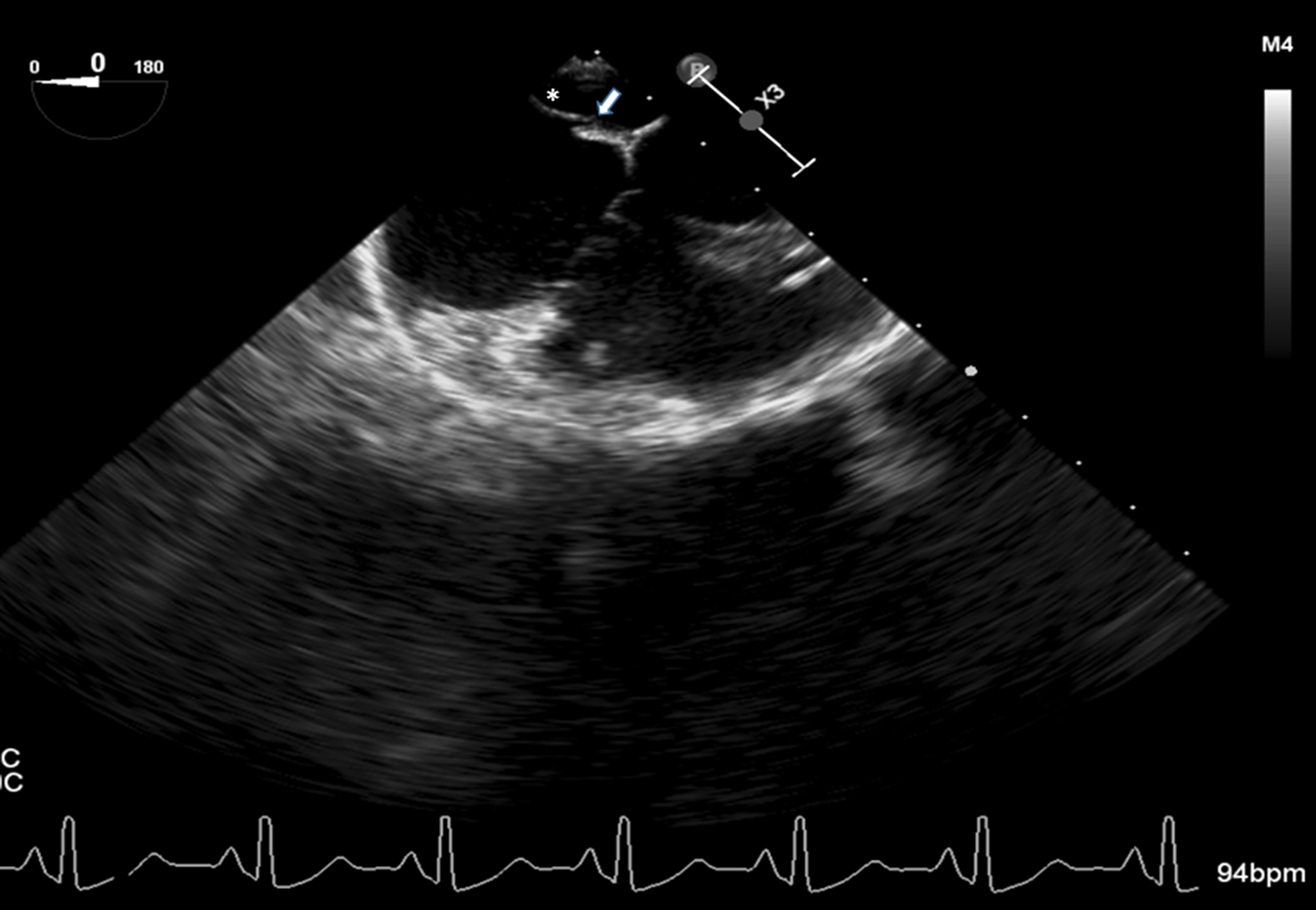 Platypnea–orthodeoxia syndrome in a child: relief of symptoms after ...