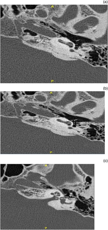 Radiological measurement of cochlear dimensions in cochlear hypoplasia ...