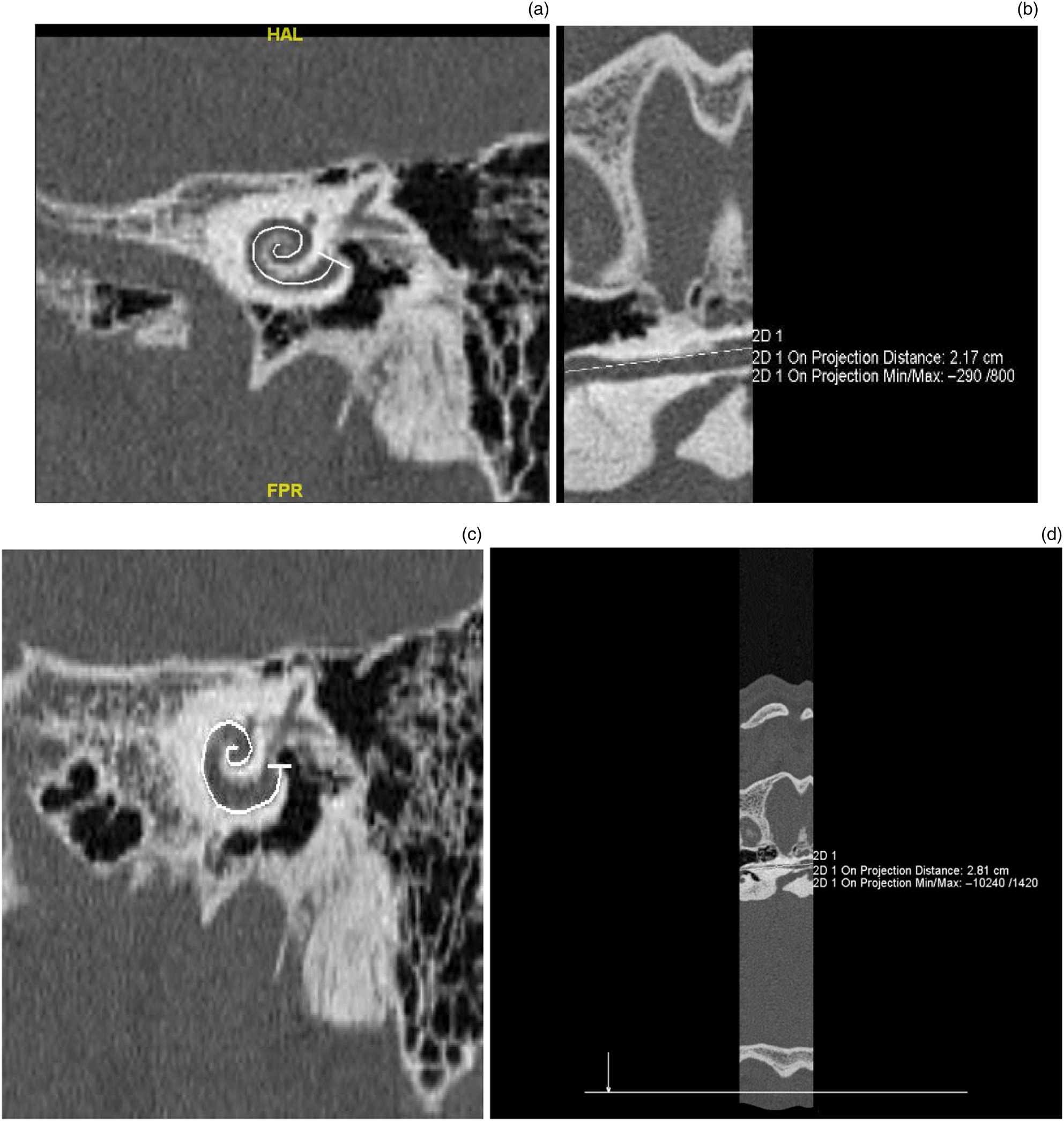 Radiological measurement of cochlear dimensions in cochlear hypoplasia ...