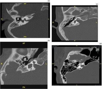 Radiological measurement of cochlear dimensions in cochlear hypoplasia ...