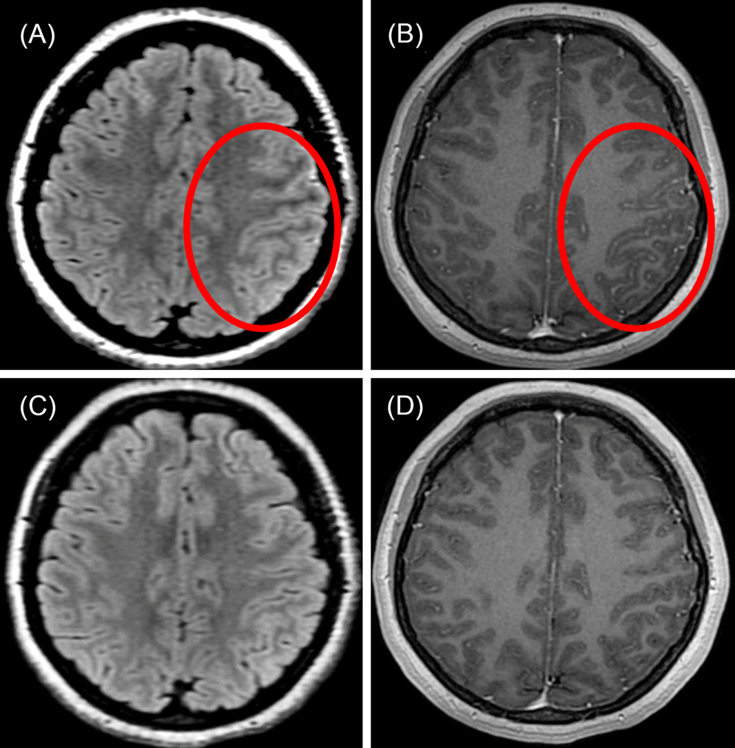 FLAIR-hyperintense Lesion in Anti-MOG-associated Encephalitis with ...