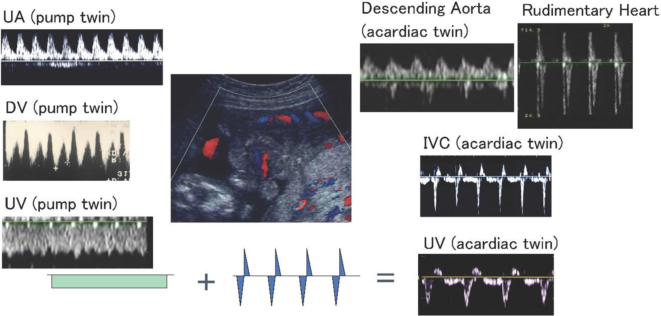 Doppler Waveform Analysis of Intertwin Venous Blood Flow in Twin ...