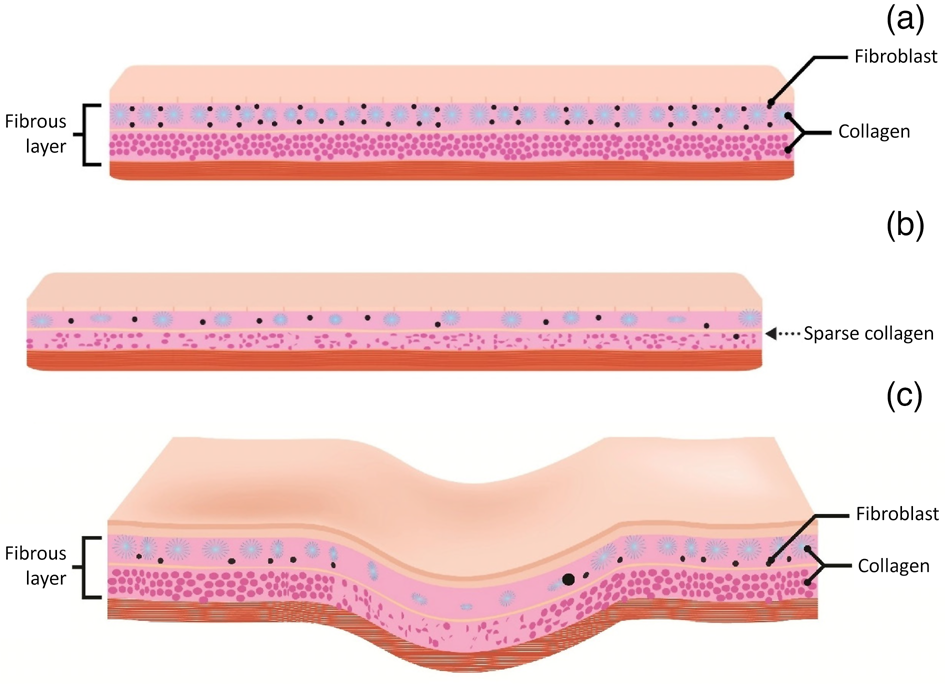 Management of retraction pockets: historic and novel approaches | The ...