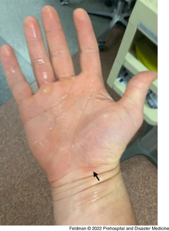 Accidental Occupational Exposure to a Large Volume of Liquid Fentanyl ...