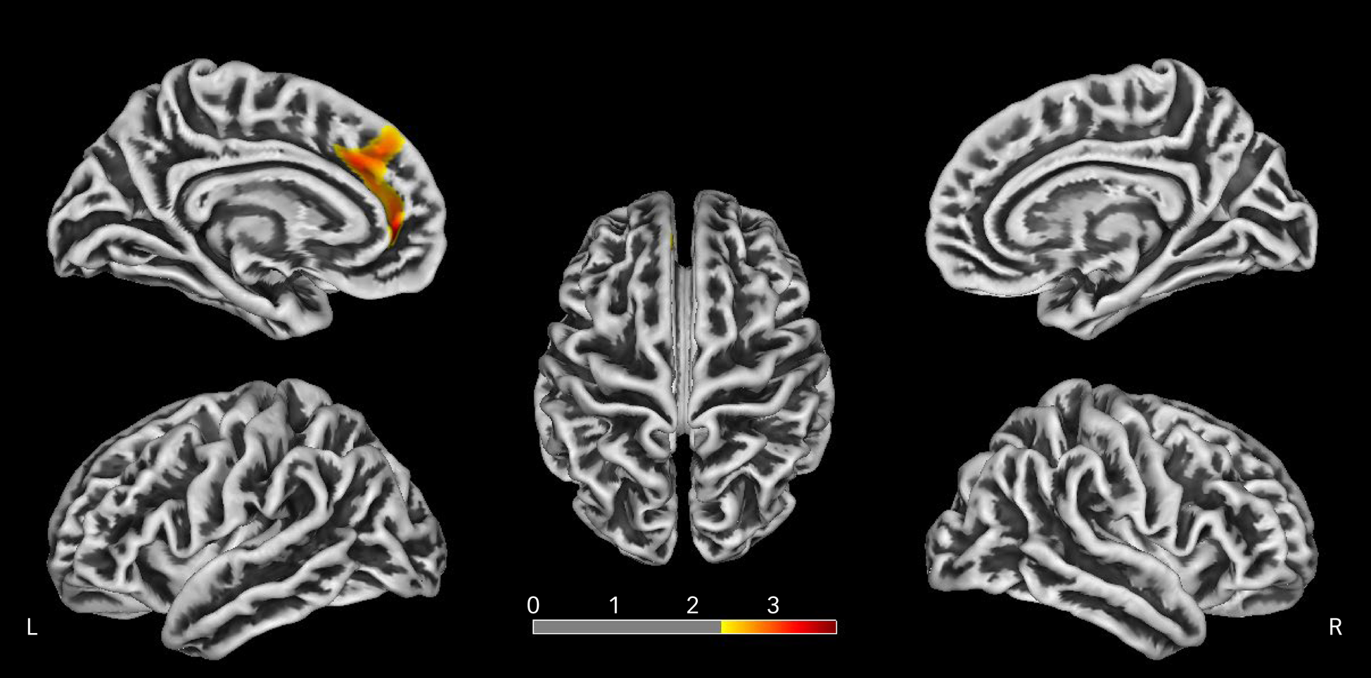 Examining the common and specific grey matter abnormalities in ...