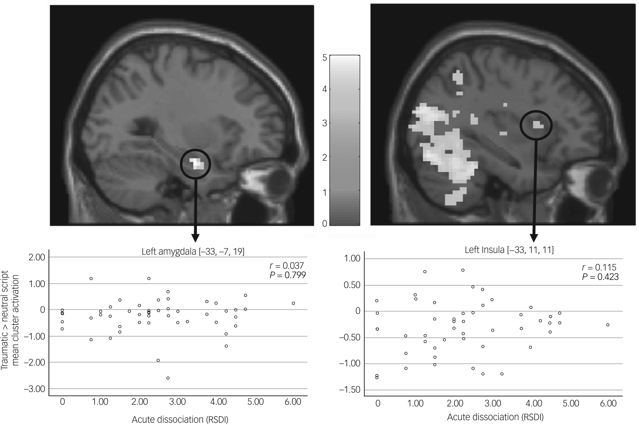 Neural correlates of acute post-traumatic dissociation: a functional ...