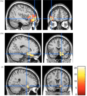 Prefrontal cortex and amygdala anatomy in youth with persistent levels ...