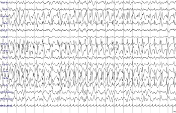 Overview of Continuous EEG Monitoring in Critically Ill Neonates and ...