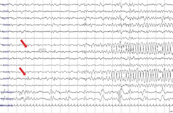 Overview of Continuous EEG Monitoring in Critically Ill Neonates and ...