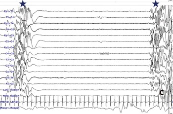 Overview of Continuous EEG Monitoring in Critically Ill Neonates and ...