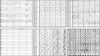 Overview of Continuous EEG Monitoring in Critically Ill Neonates and ...