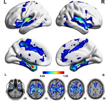 Local dynamic spontaneous brain activity changes in first-episode ...