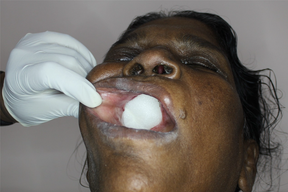 Temporary obturator using high-density polyurethane foam following ...