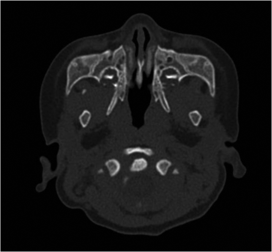 Congenital inferior turbinate hypertrophy: an overlooked entity in ...