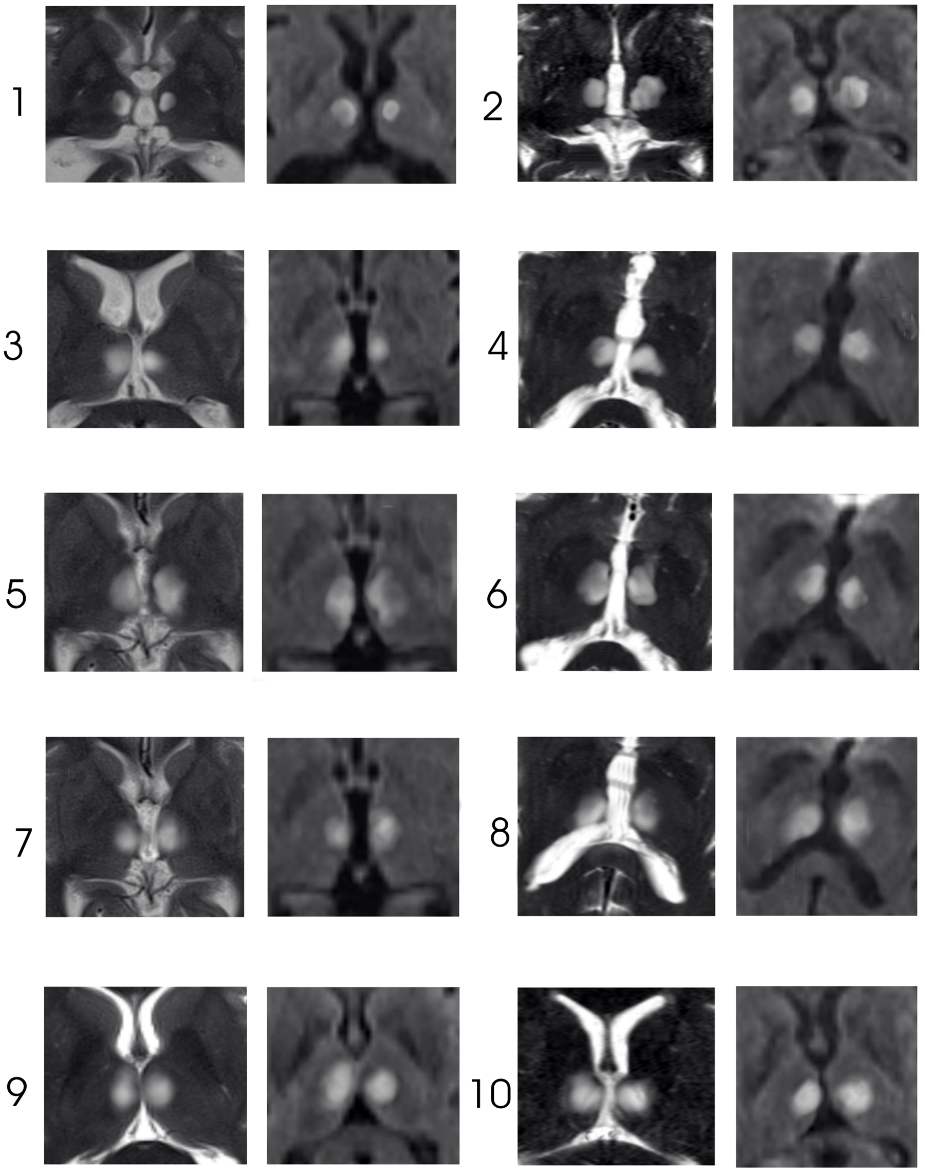 The Clinical and Cognitive Spectrum of Artery of Percheron Infarction ...