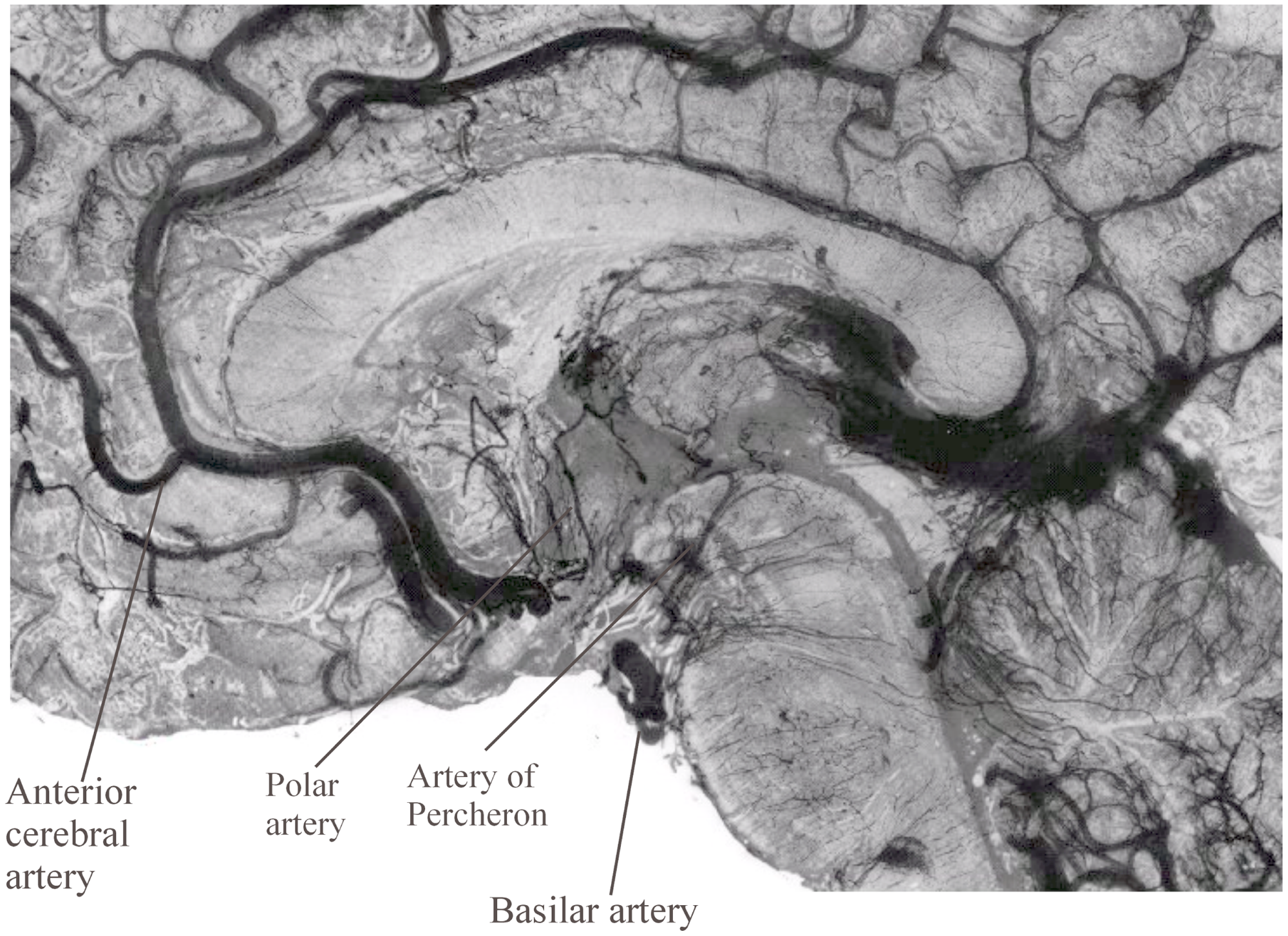 The Clinical and Cognitive Spectrum of Artery of Percheron Infarction ...