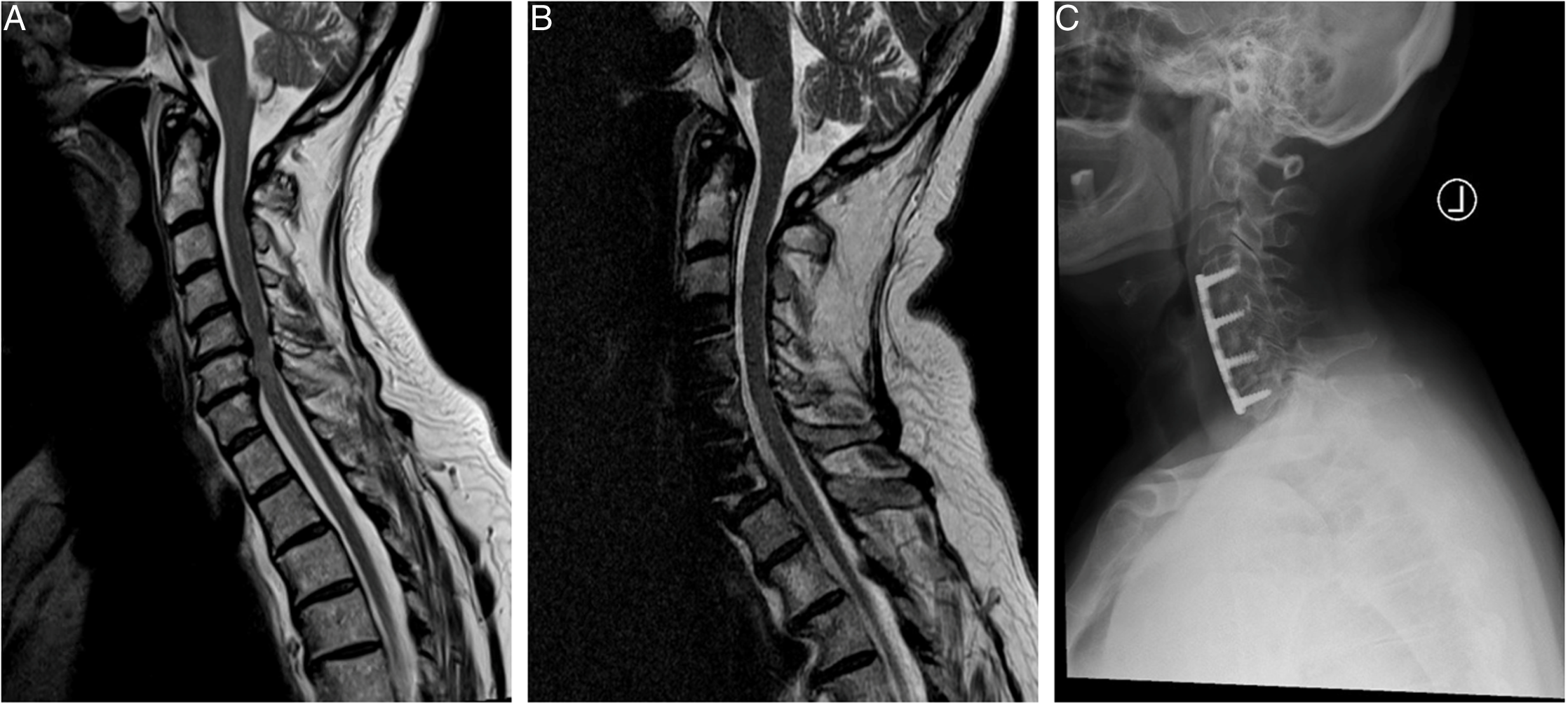 Degenerative Cervical Myelopathy: Towards a Personalized Approach ...