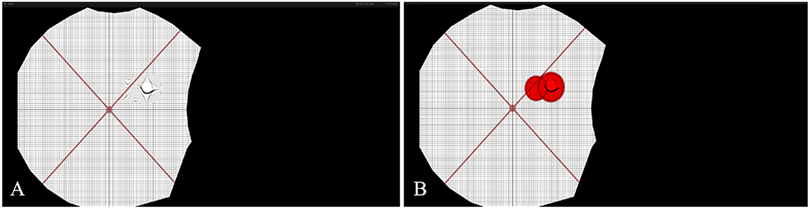 Head-mounted digital metamorphopsia suppression as a countermeasure for macular-related visual ...