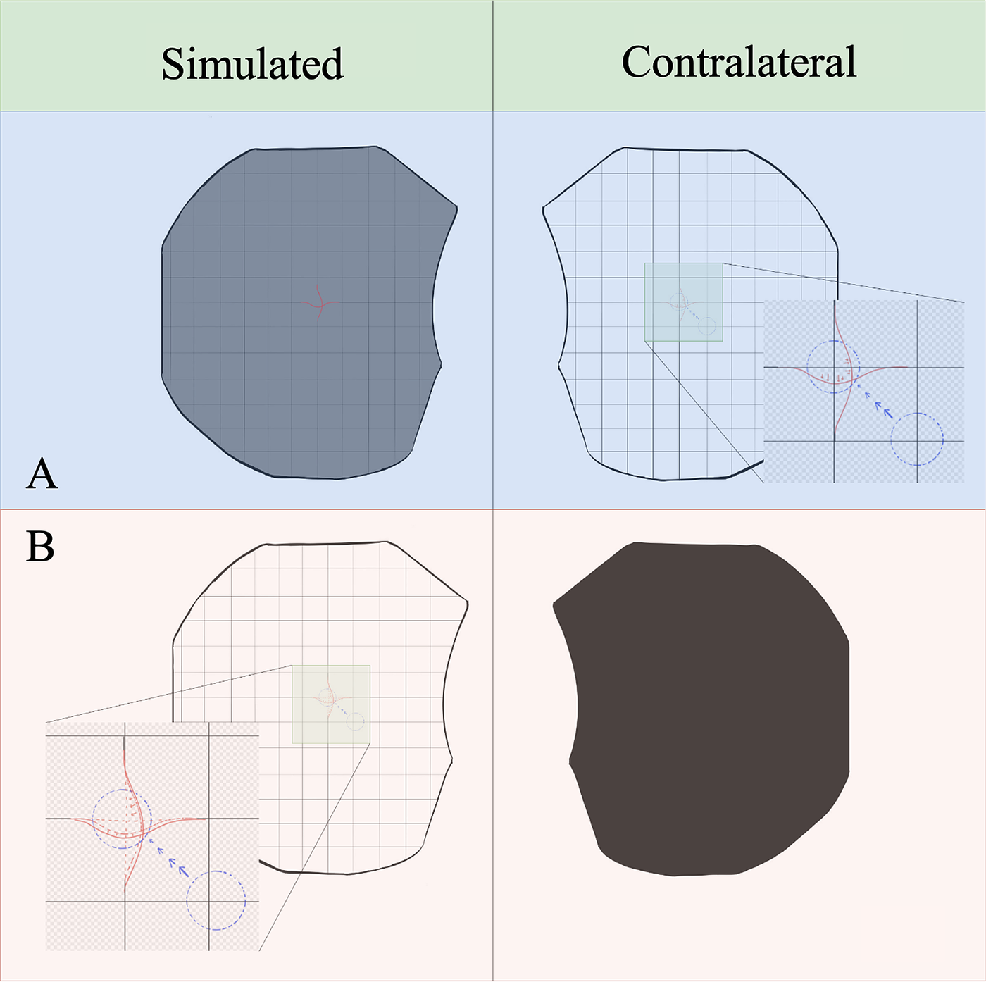 Head-mounted digital metamorphopsia suppression as a countermeasure for macular-related visual ...