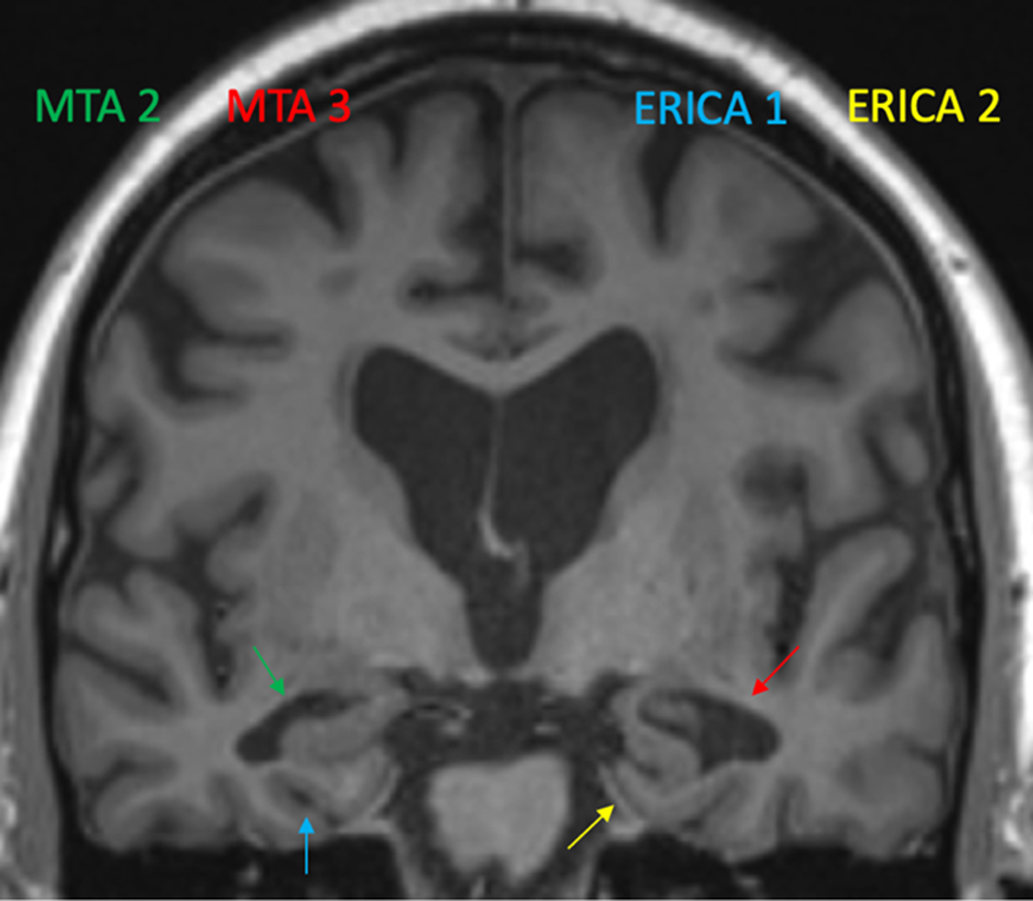 Specificity of Entorhinal Atrophy MRI Scale in Predicting Alzheimer’s ...