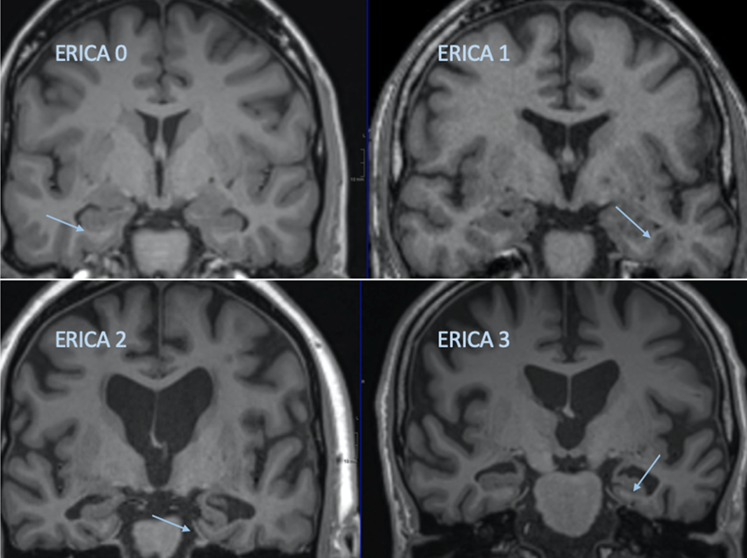 Specificity of Entorhinal Atrophy MRI Scale in Predicting Alzheimer’s ...