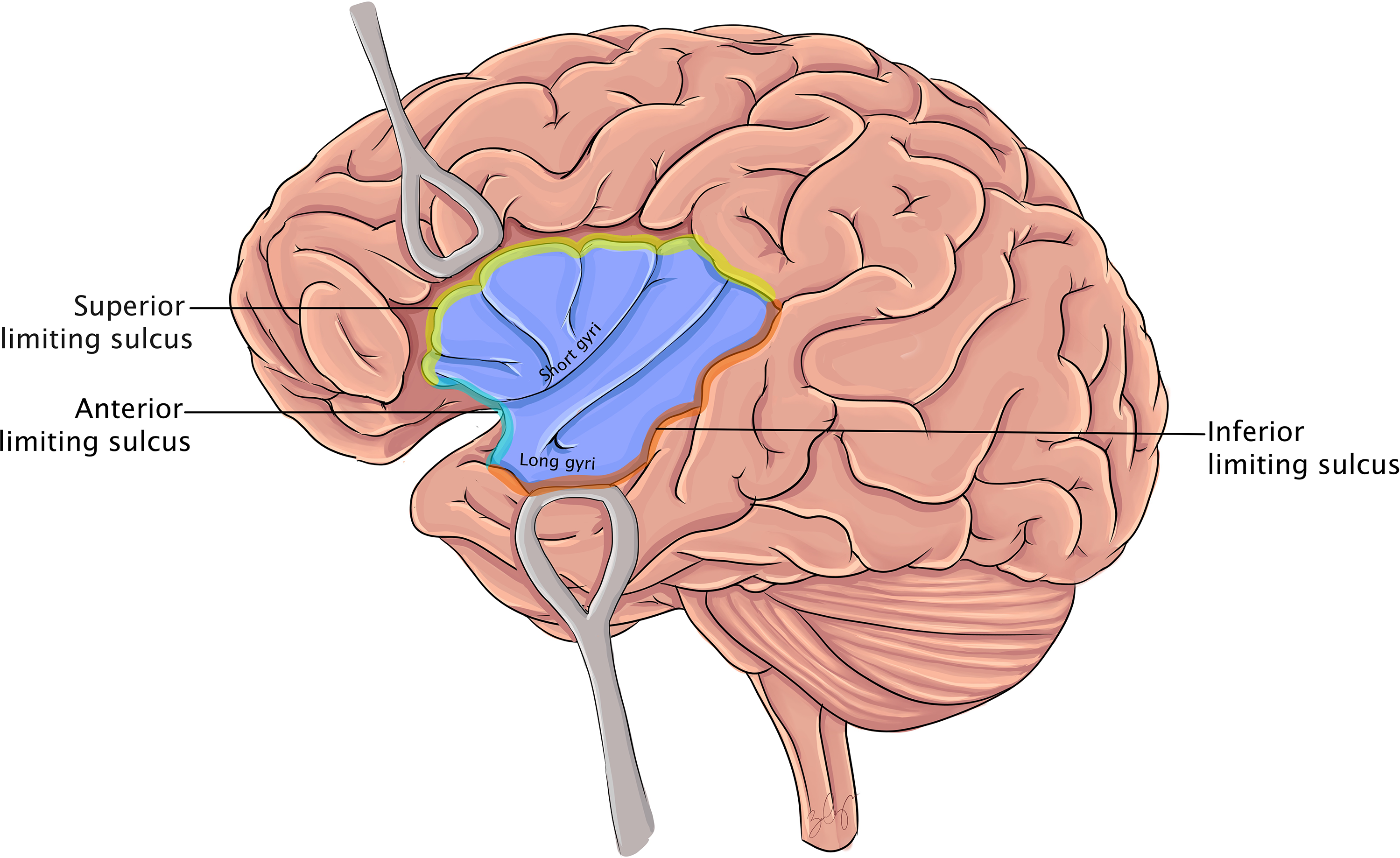 A Review on the Surgical Management of Insular Gliomas | Canadian ...