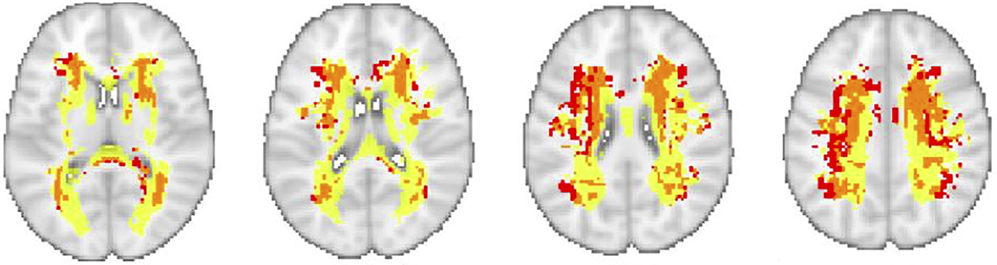 Impact of obesity and diet on brain structure and function: a gut–brain ...