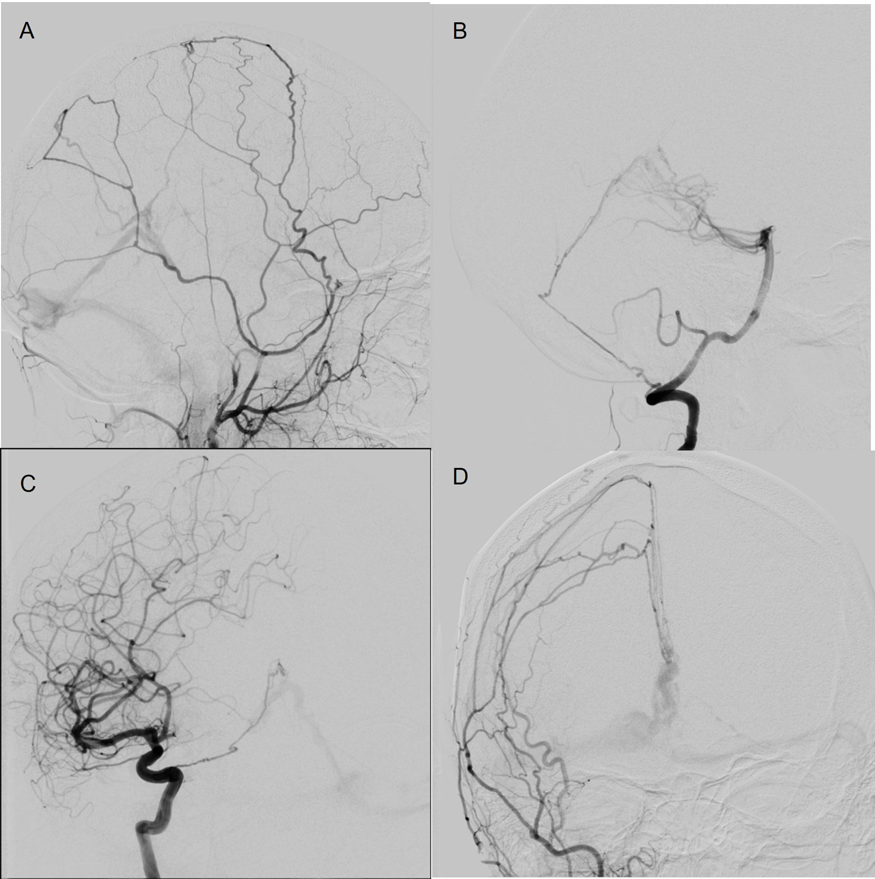 Transvenous Embolization of Dural Arteriovenous Fistulas with Cortical ...