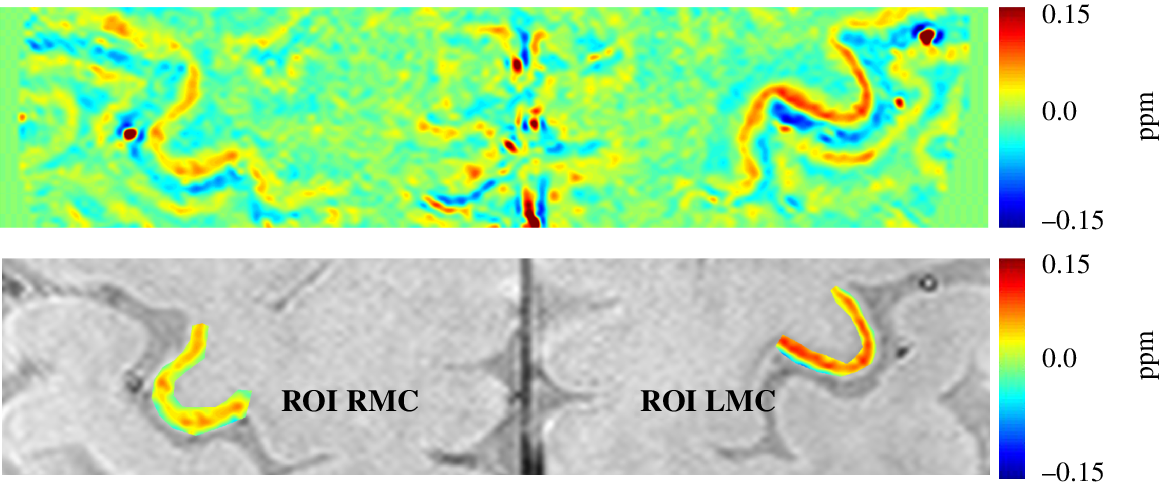 Motor Band Sign in Motor Neuron Disease: A Marker for Upper Motor ...
