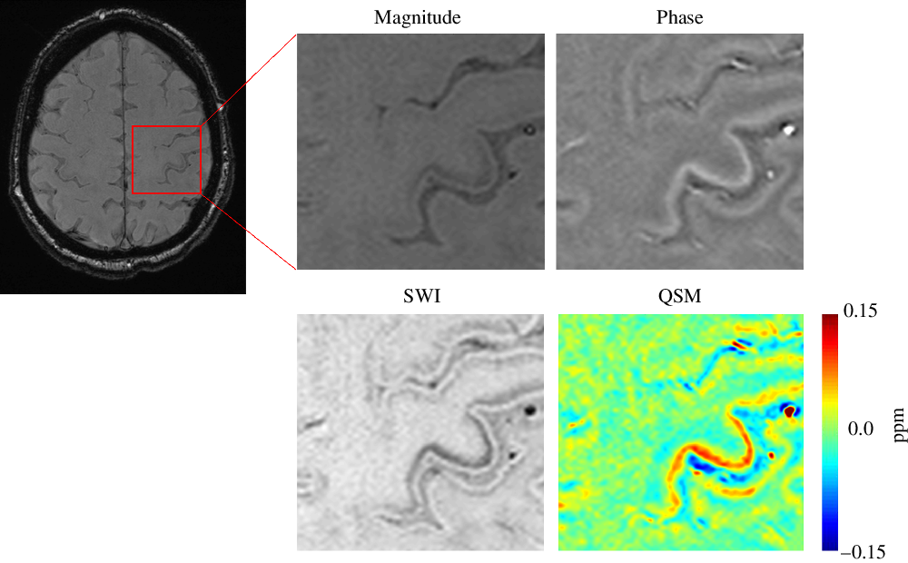 Motor Band Sign in Motor Neuron Disease: A Marker for Upper Motor ...