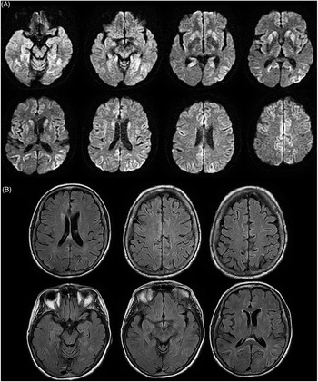 Reduplicative paramnesia as an atypical form of presentation of a ...