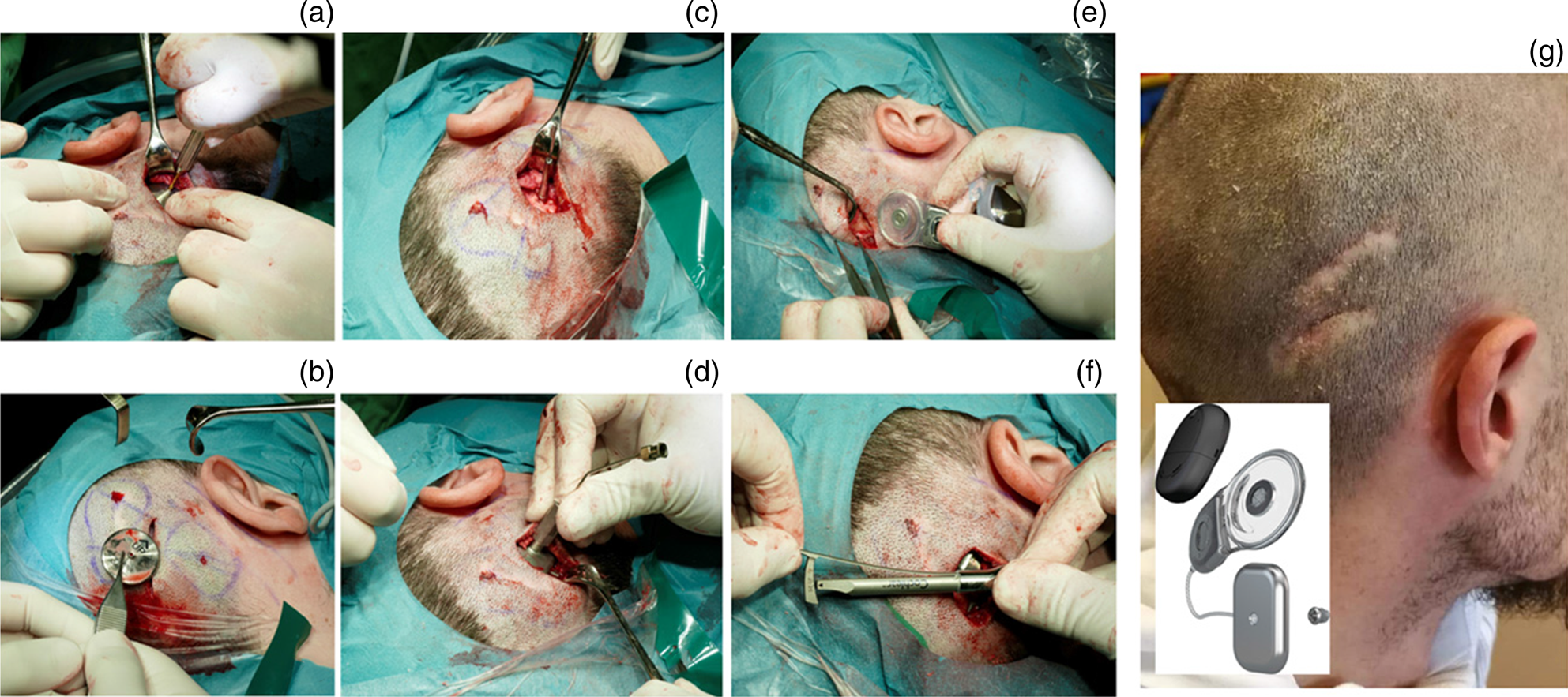 BAHA Attract to Osia conversion patients: comparison of the two systems ...
