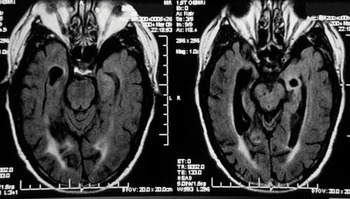 The Amnesic Syndrome (Chapter 1) - Insights into Clinical Neurology