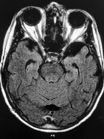 The Amnesic Syndrome (Chapter 1) - Insights into Clinical Neurology