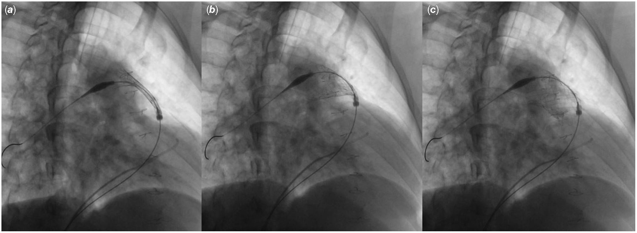 Early results of Pulsta® transcatheter heart valve in patients with ...
