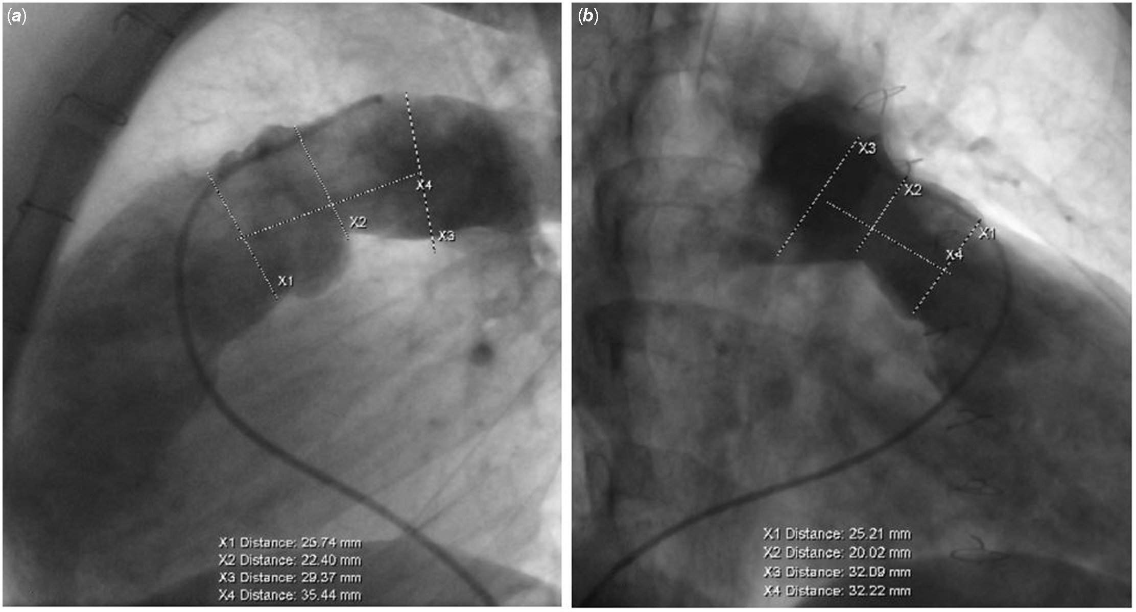 Early results of Pulsta® transcatheter heart valve in patients with ...
