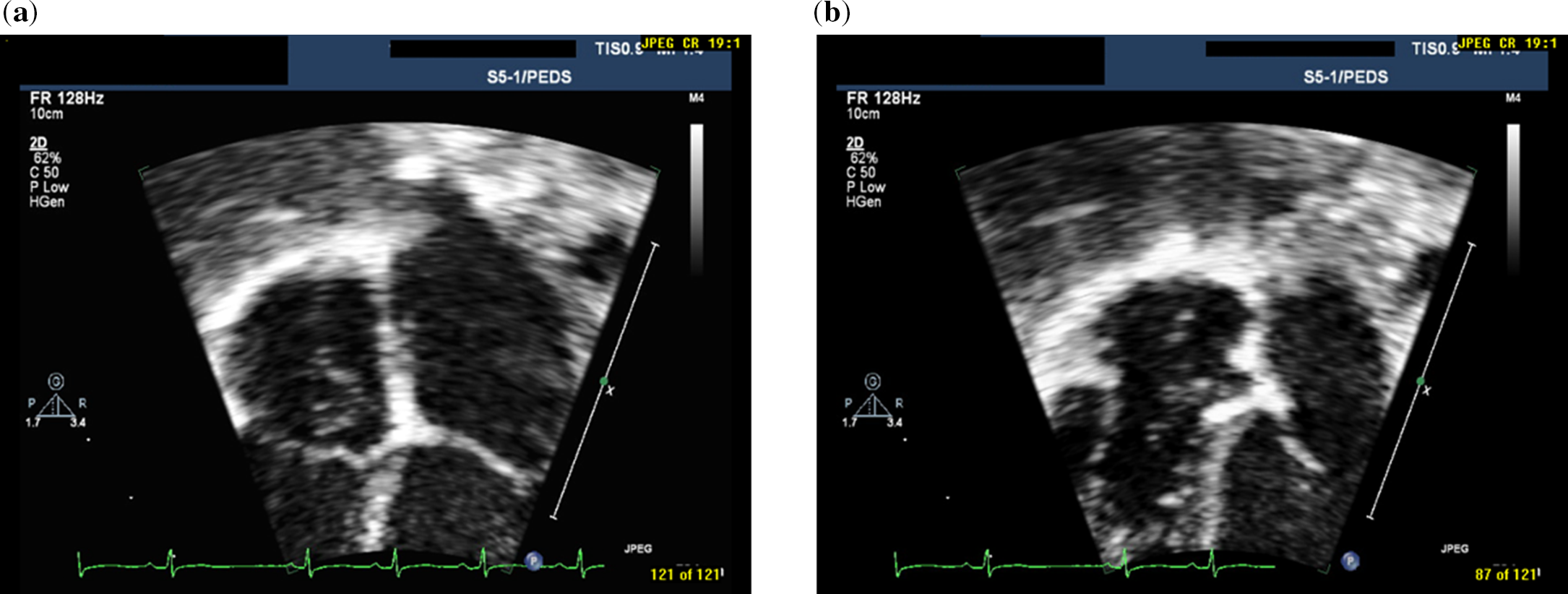 Prominent prolapsing Chiari network: presentation and prognosis in ...