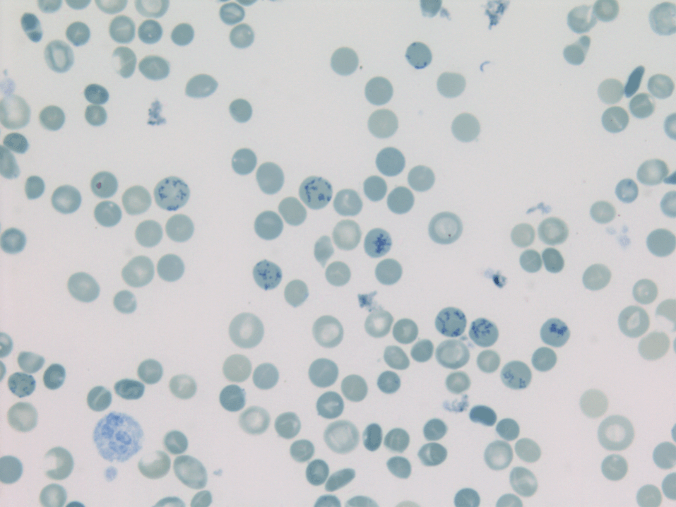 Peripheral Blood Smear Review (Chapter 1) - Atlas of Pediatric ...
