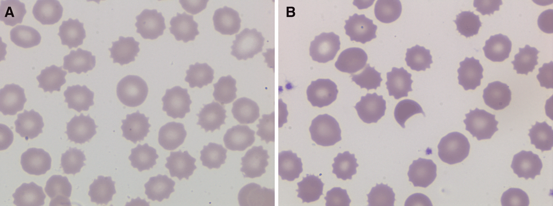 Peripheral Blood Smear Review (Chapter 1) - Atlas of Pediatric ...