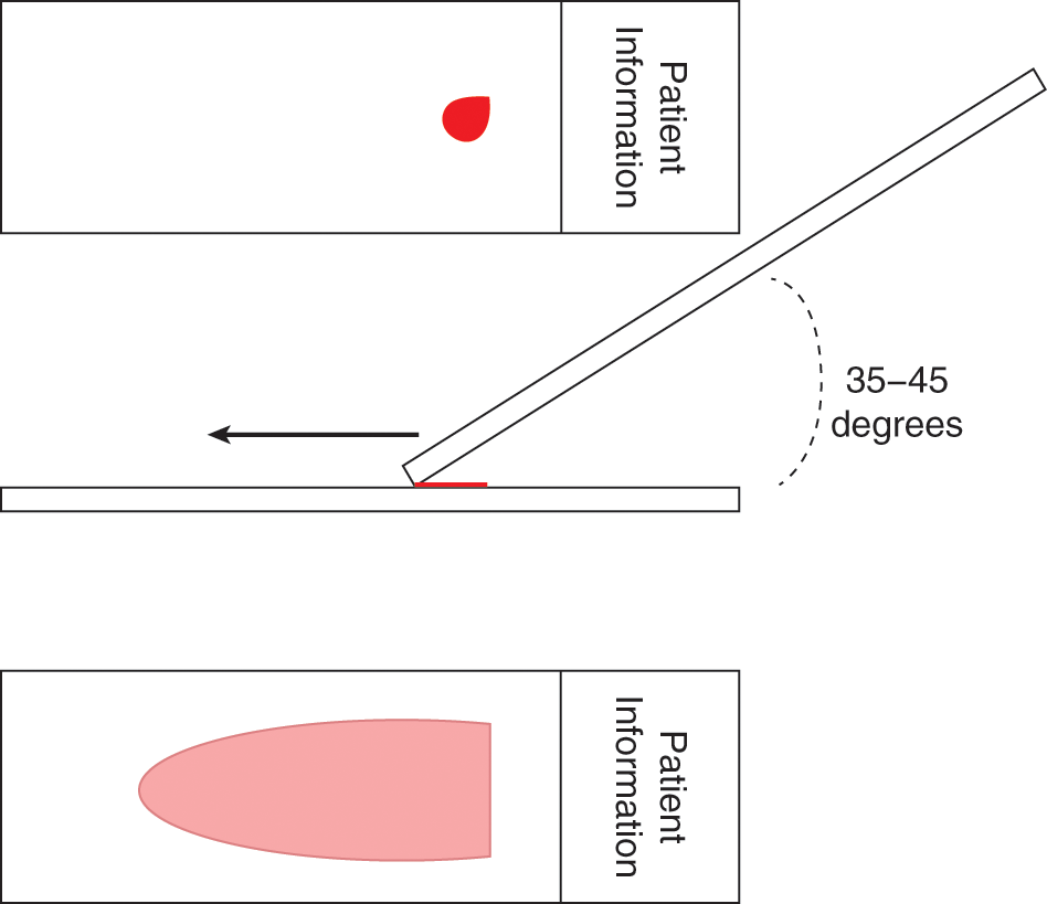 Peripheral Blood Smear Review (Chapter 1) - Atlas of Pediatric ...