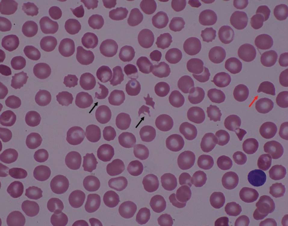 Peripheral Blood Smear Review (Chapter 1) - Atlas of Pediatric ...