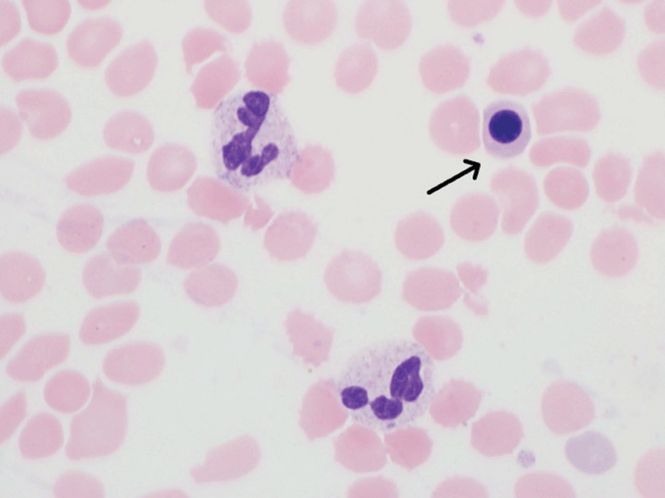 Peripheral Blood Smear Review (Chapter 1) - Atlas of Pediatric ...
